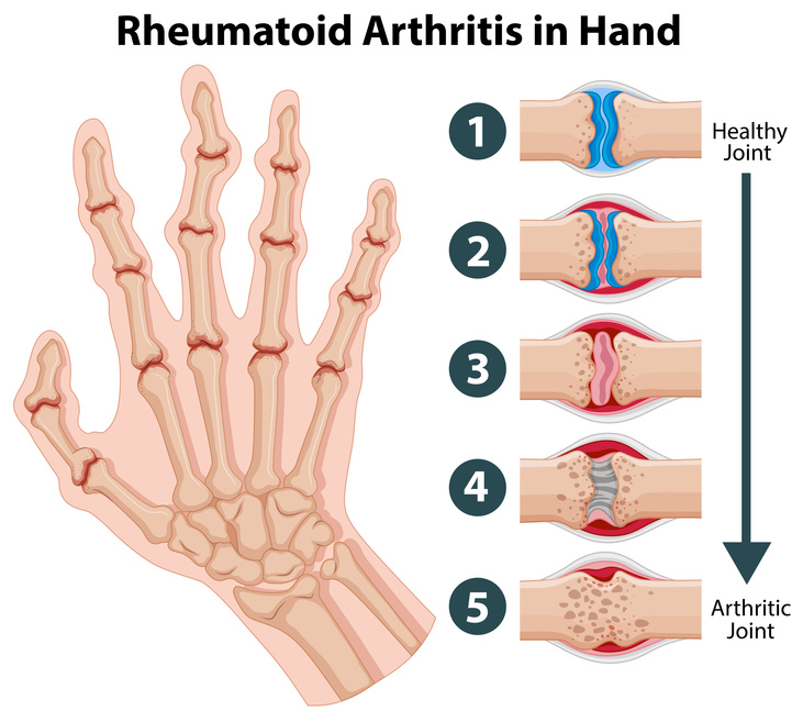 Clinical Review Of Vardhamana Pippali Rasayana In The Treatment Of ...